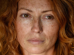 Solar elastosis – SKiN Health